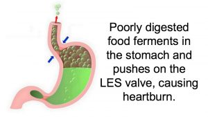 What Causes Heartburn?